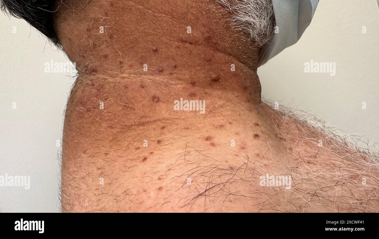 Papules on the neck and shoulders of a Hispanic male patient caused by ...