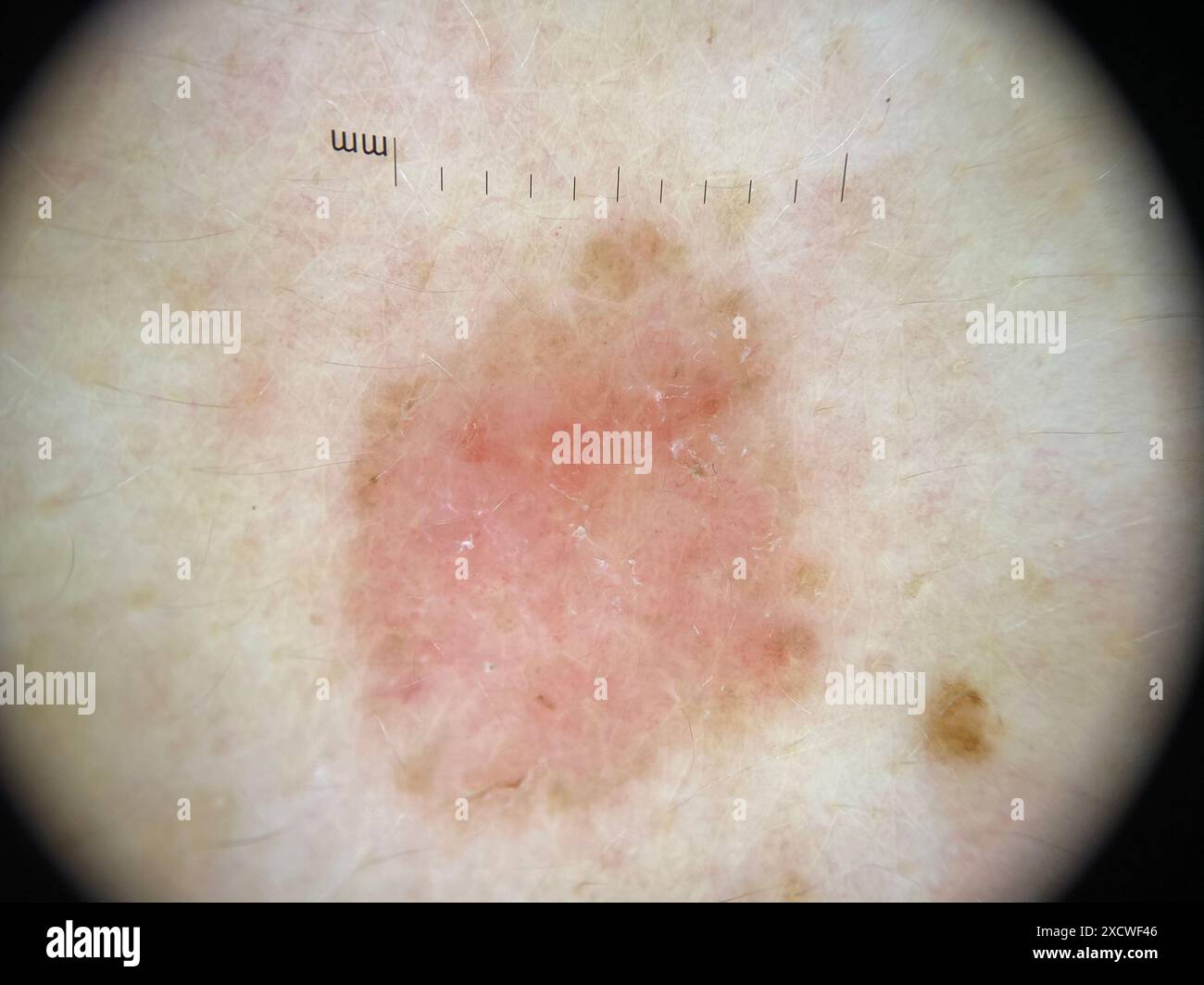 Dermatoscope image of a superficial basal cell carcinoma on the skin of ...