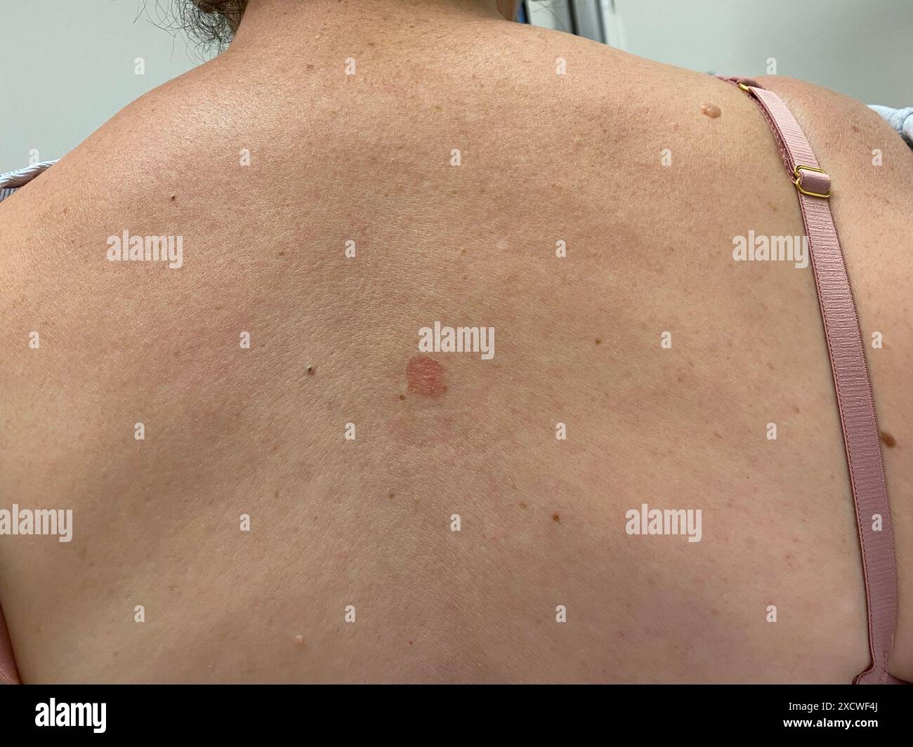 Superficial basal cell carcinoma on the back of a 58 year old Hispanic ...