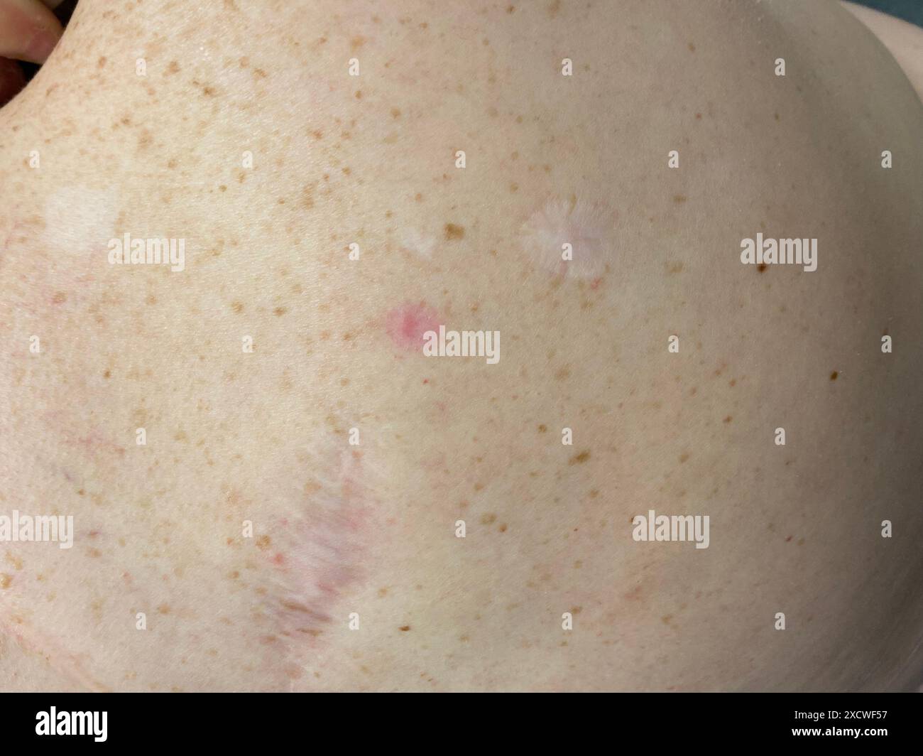 Scar from superficial basal cell carcinoma biopsy. Basal cell carcinoma ...