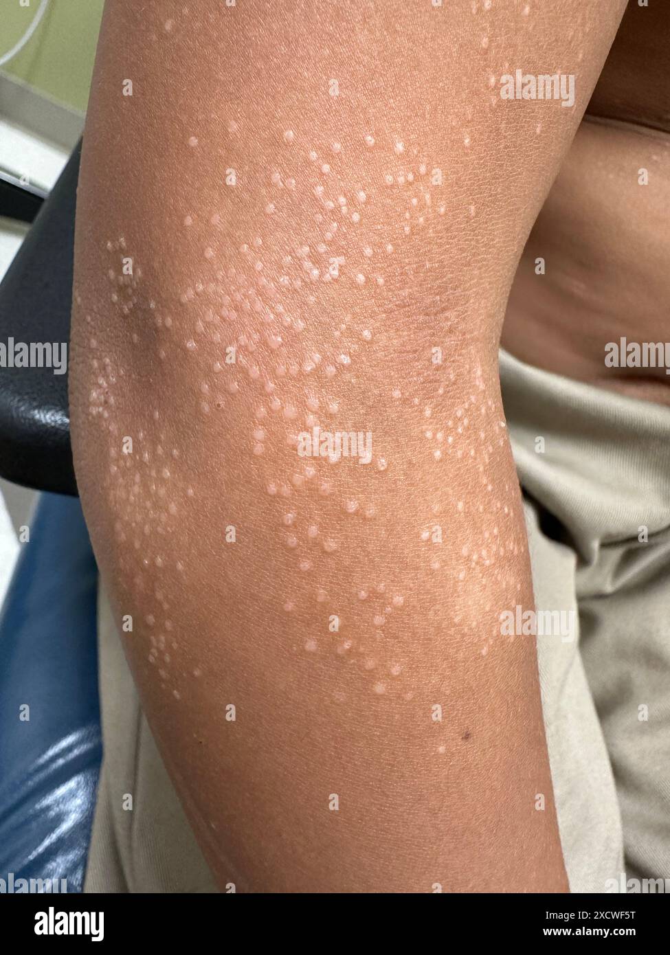 Papules on the arm of a 5 year old Hispanic boy due to lichen nitidus ...