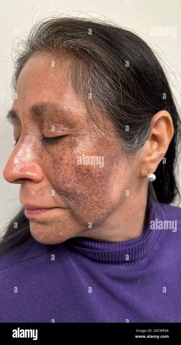Face of a female patient with lichen planus pigmentosus. This is a rare ...