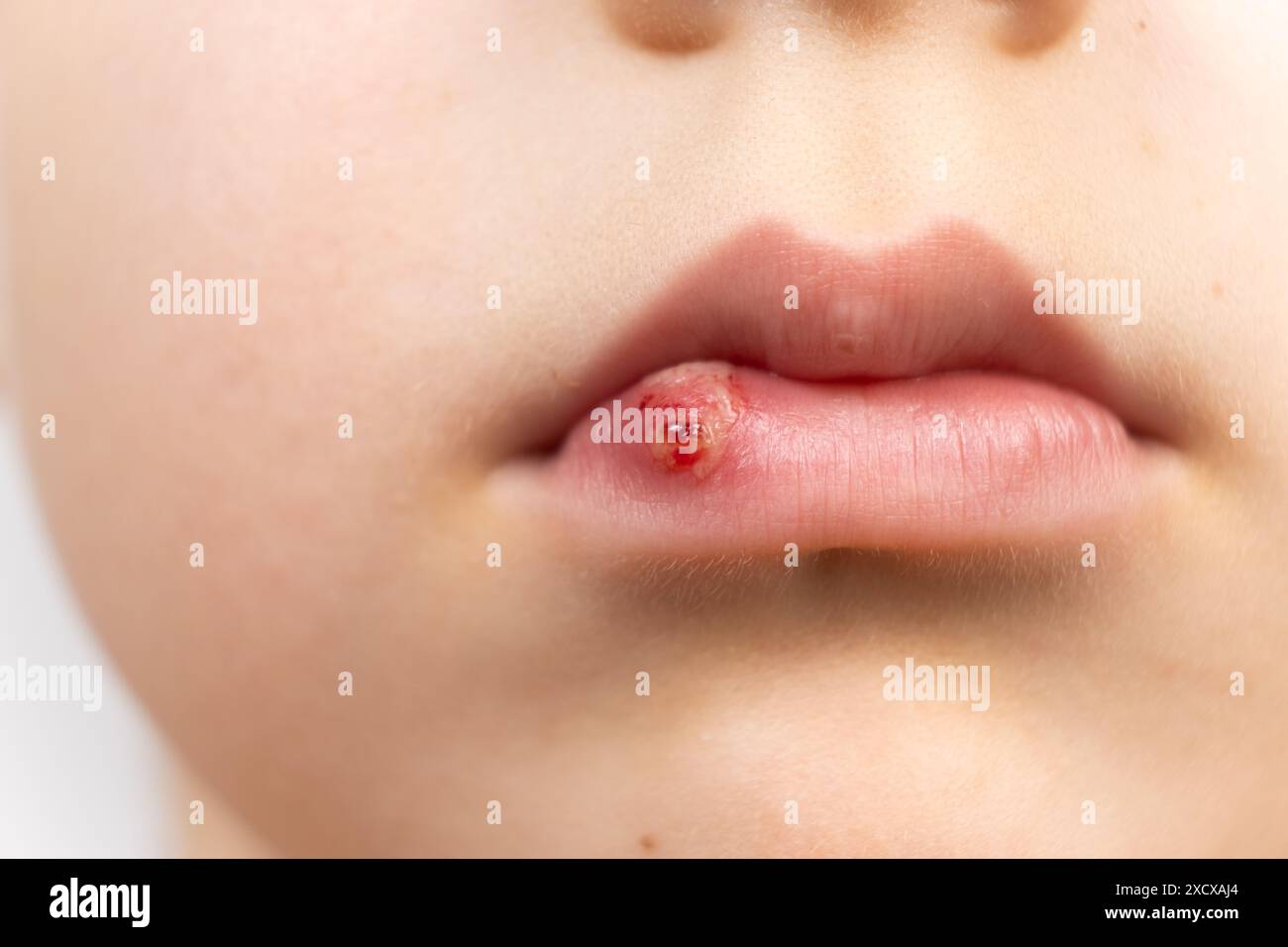 Skin damage, wound, abrasion on the lip of a small child Stock Photo ...