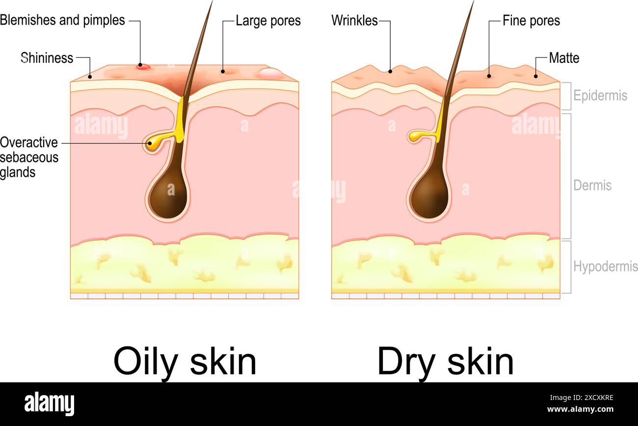 Oily and Dry skin. Skin types. Cross section of a human skin with ...