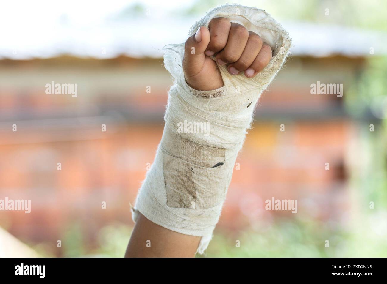 Injured Hand in Cast Raised Against Blurry Background. Remember the ...