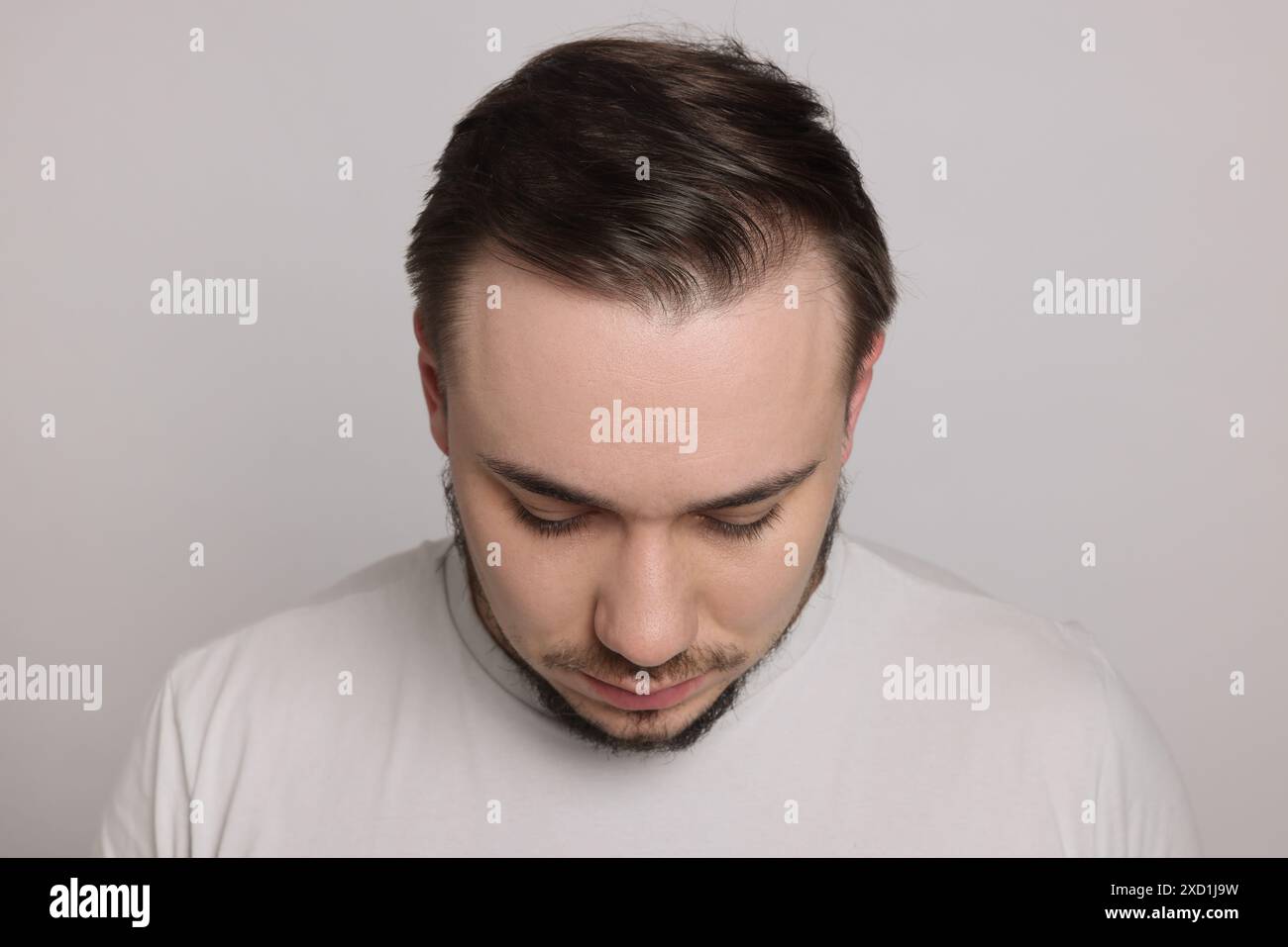 Baldness concept. Sad man with receding hairline on light grey ...
