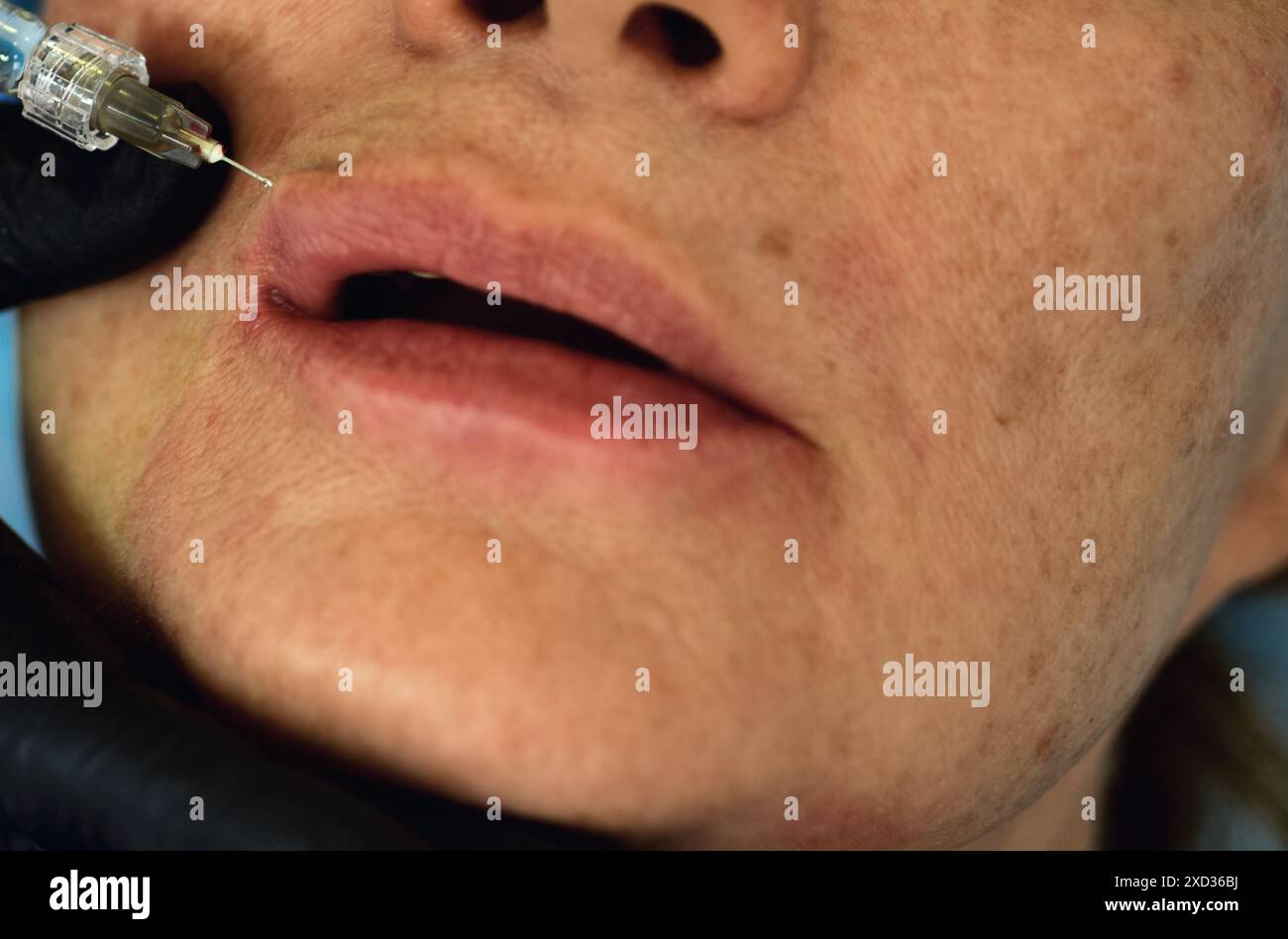 Filler injections. Closeup mature woman lips, procedure augmentation ...