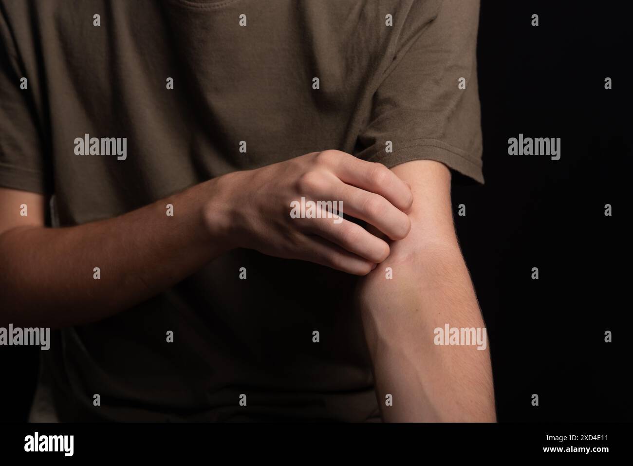 Black skin chickenpox hi-res stock photography and images - Alamy