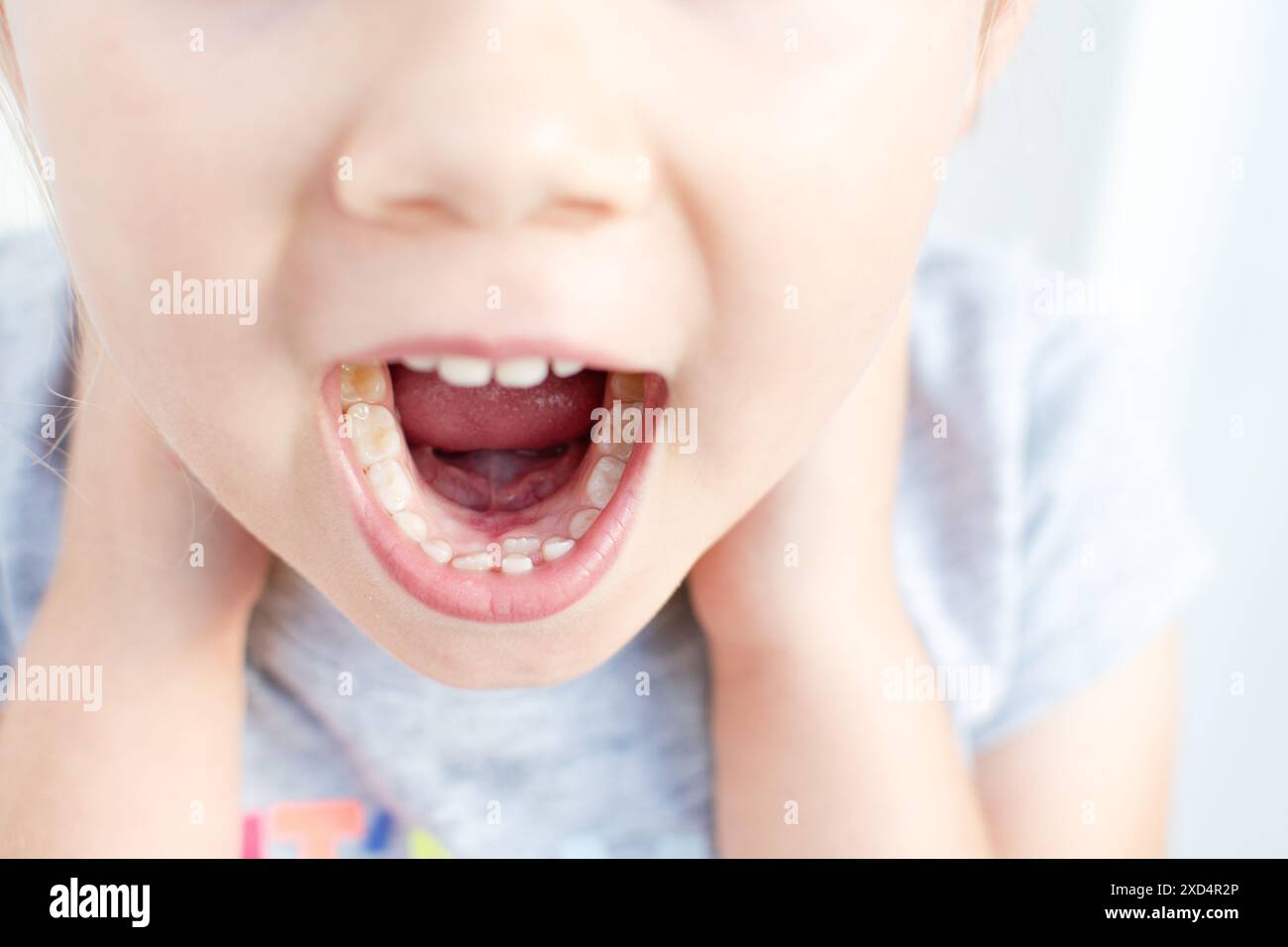 Adult permanent teeth coming in front of the child's baby teeth: shark ...