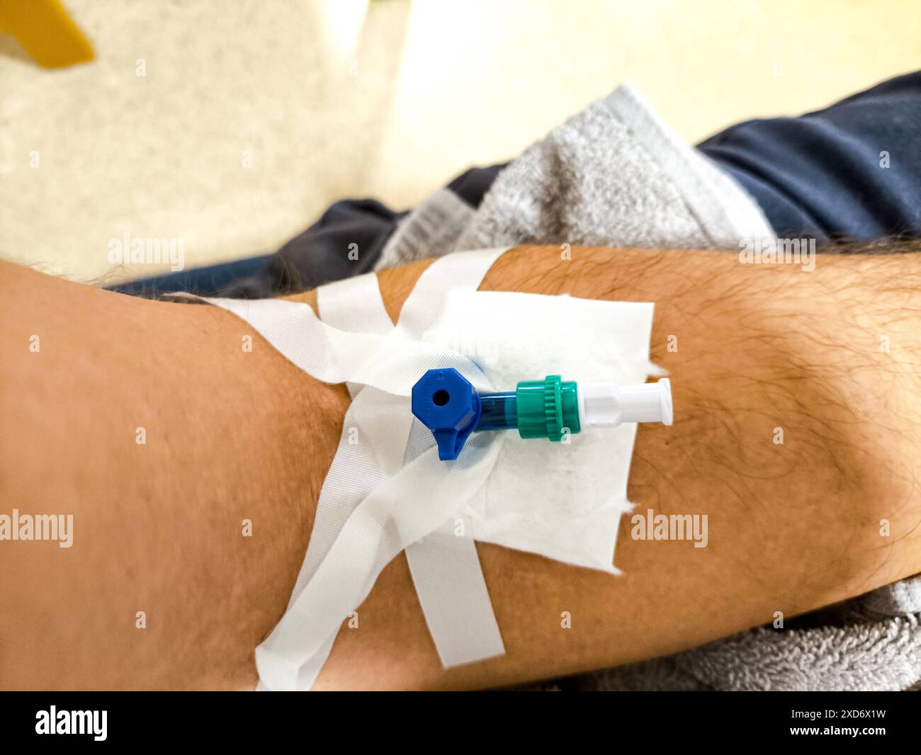 Germany - June 20, 2024: Arm, with intravenous cannula Venflon in place ...