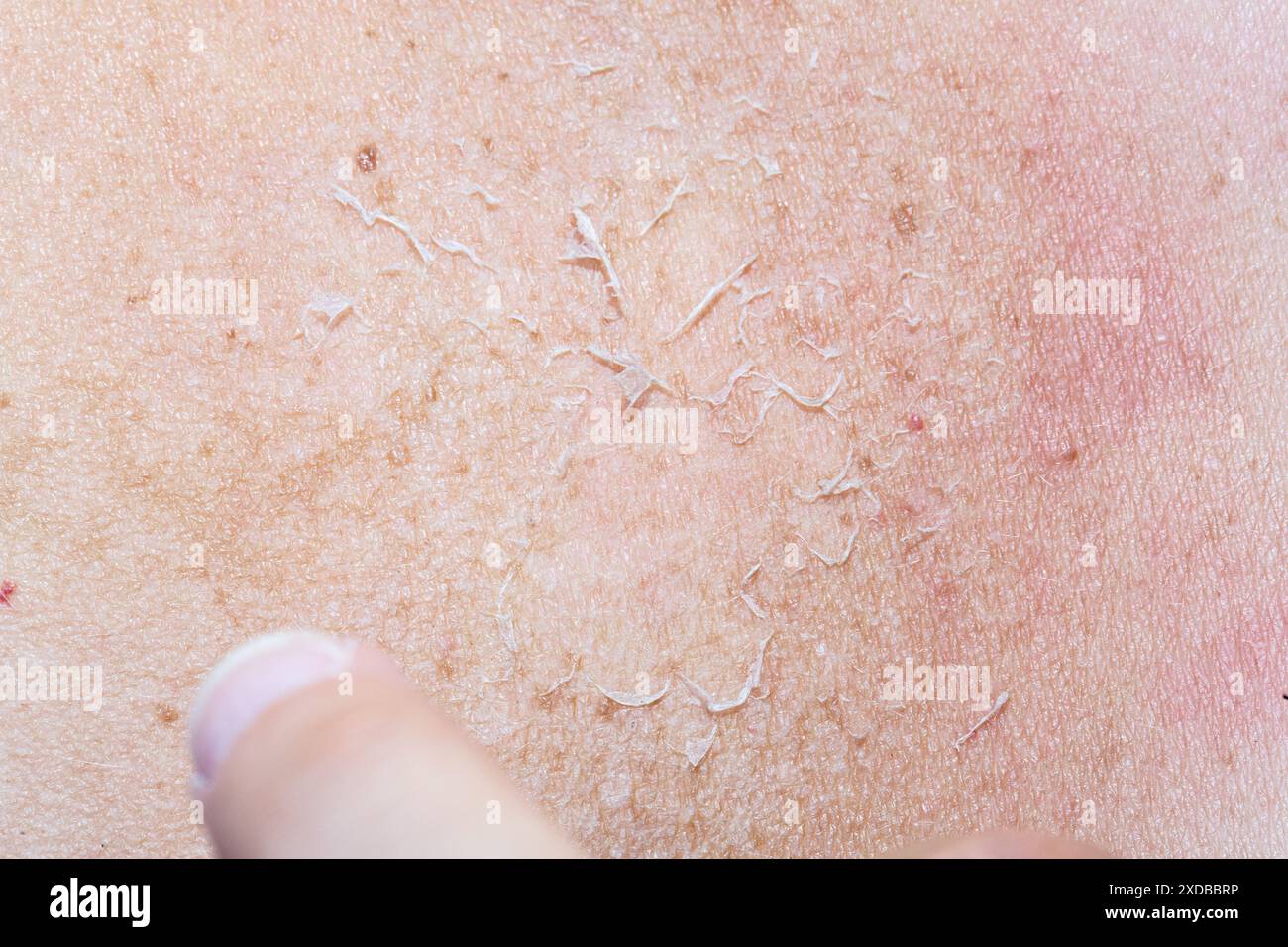 Macro of dry skin, finger peeling off shreds of dehydrated skin from ...