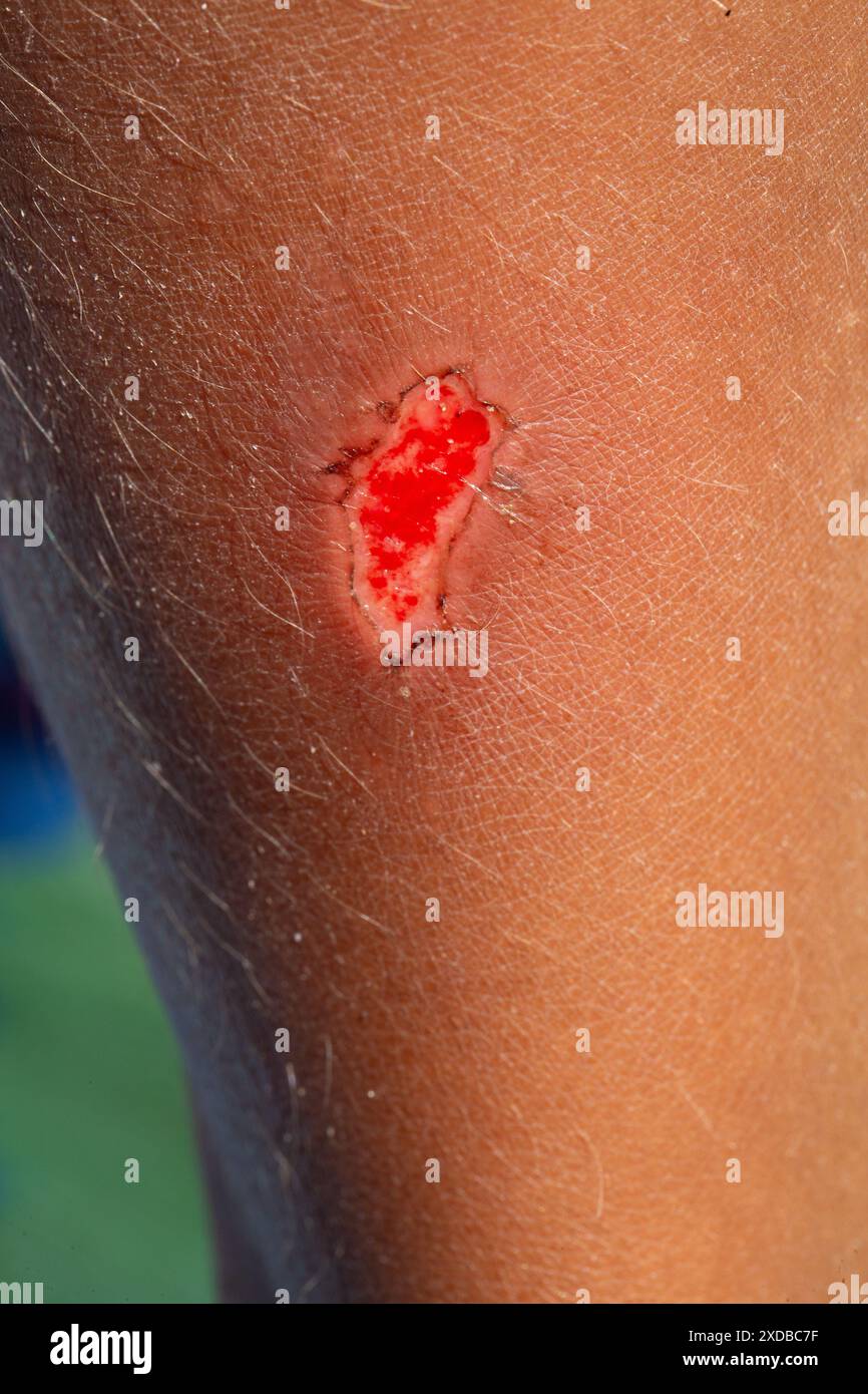 Human skin with a bleeding open wound. Deep unhealed abrasion with fresh blood Stock Photo - Alamy
