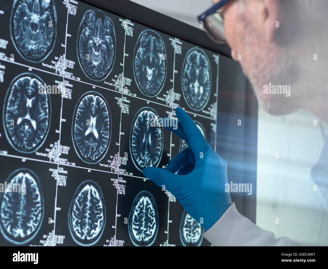Scientist viewing a patient's brain MRI (magnetic resonance imaging ...
