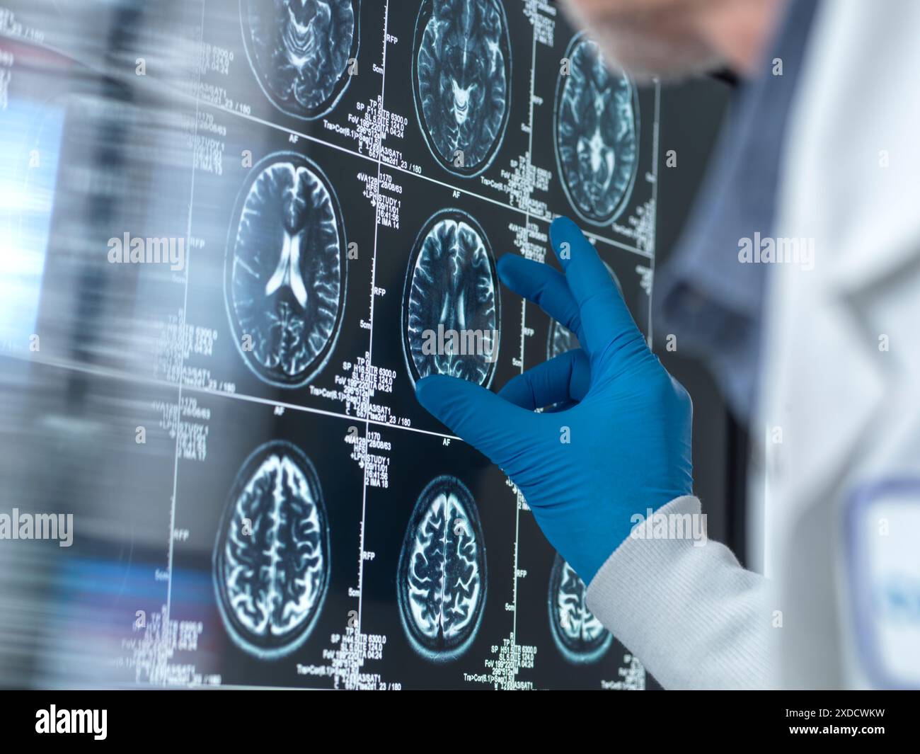 Scientist viewing a patient's brain MRI (magnetic resonance imaging ...