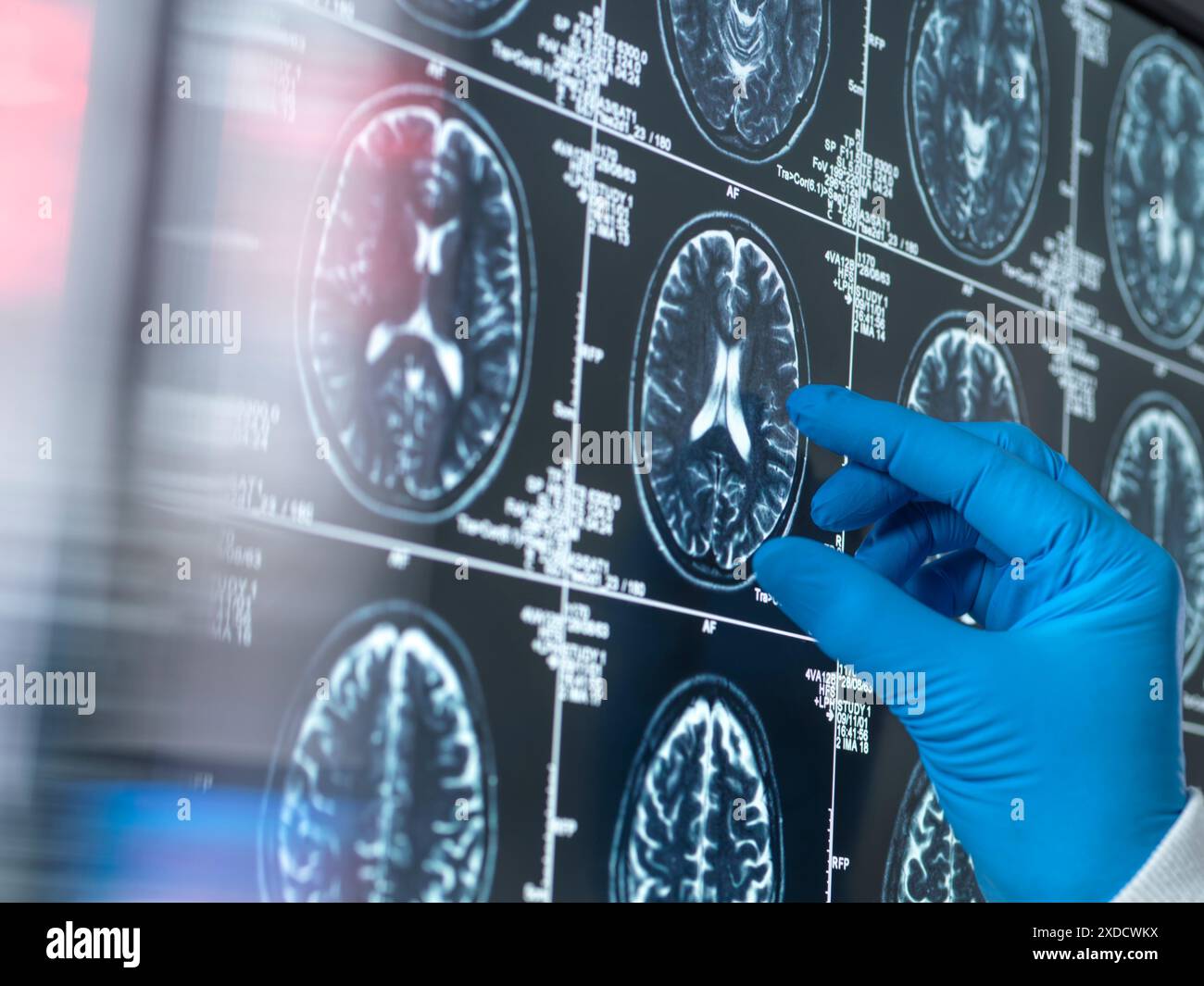 Scientist viewing a patient's brain MRI (magnetic resonance imaging) scan for ageing and damage ...