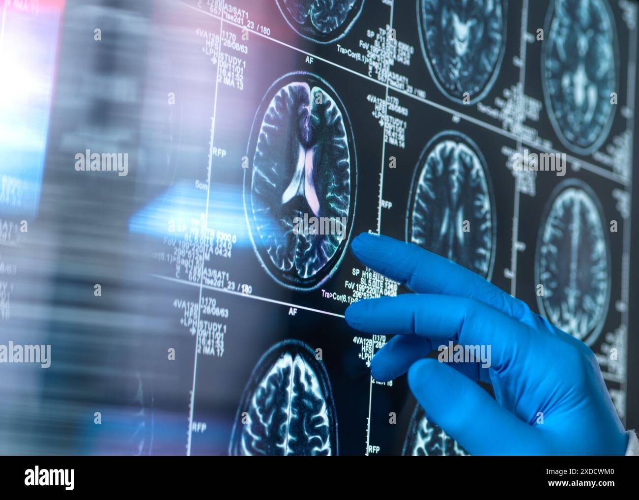 Scientist viewing a patient's brain MRI (magnetic resonance imaging ...