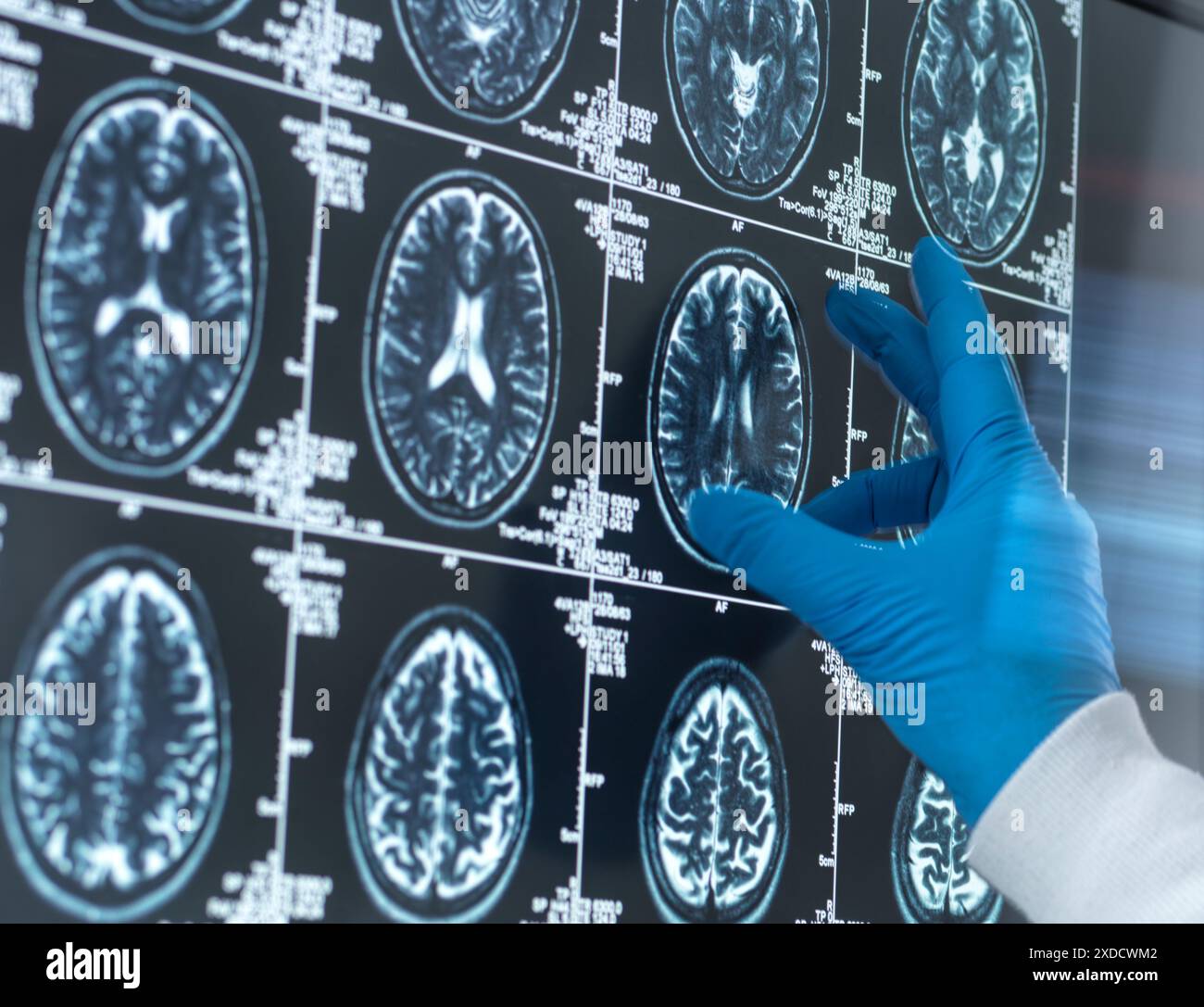 Scientist viewing a patient's brain MRI (magnetic resonance imaging ...