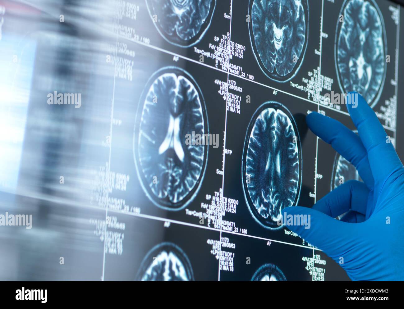 Scientist viewing a patient's brain MRI (magnetic resonance imaging ...