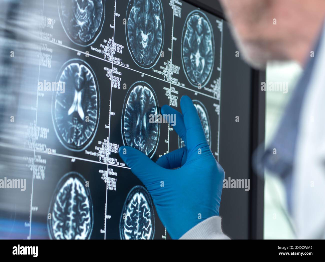 Scientist viewing a patient's brain MRI (magnetic resonance imaging ...