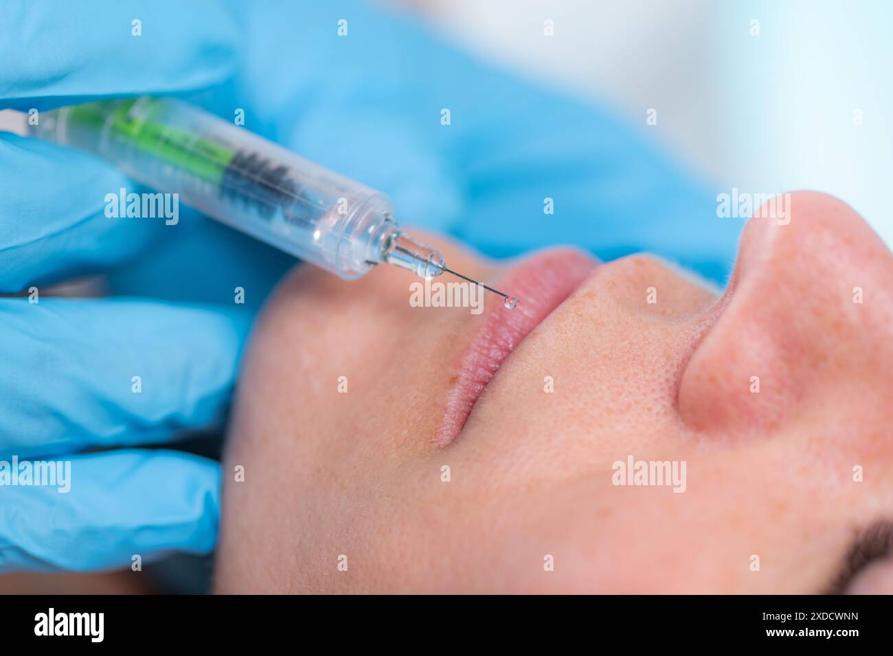 Treating lips with hyaluronic acid filler, a dermatology treatment that ...