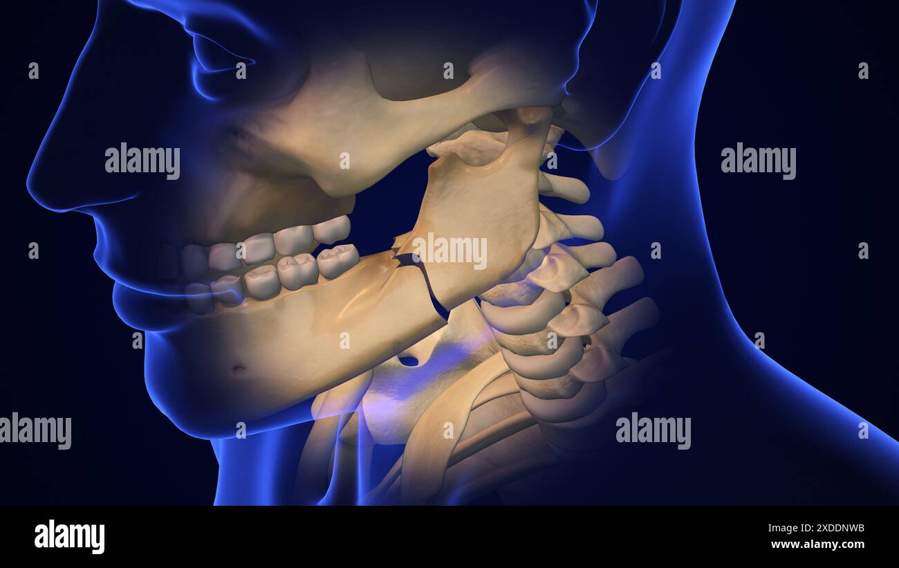 Broken Jaw joint with Metal Plate and Screws Stock Photo - Alamy