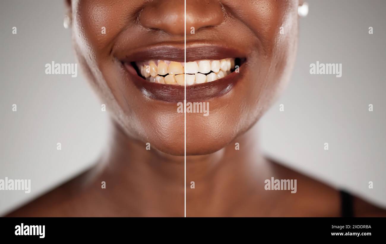 dental collage showcasing a smiling African American woman's teeth ...