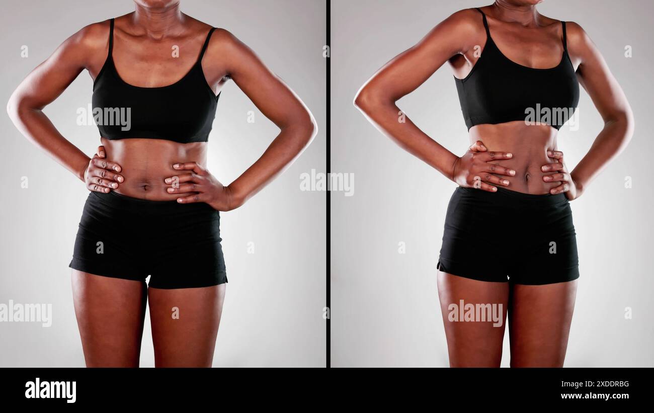 Transformation: From Obesity to Abdominoplasty - Witness the incredible journey of an African ...