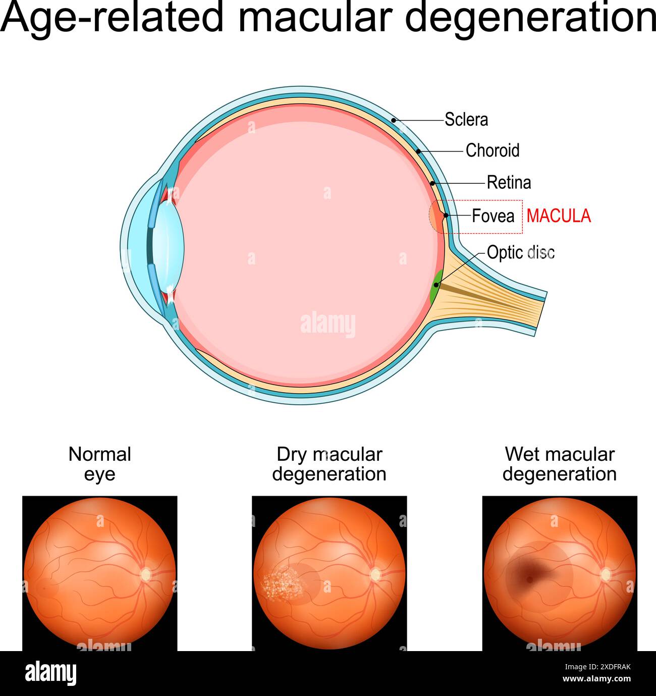 Macular Degeneration Age Related Macular Degeneration Cross Section Of Human Eye Close Up Of