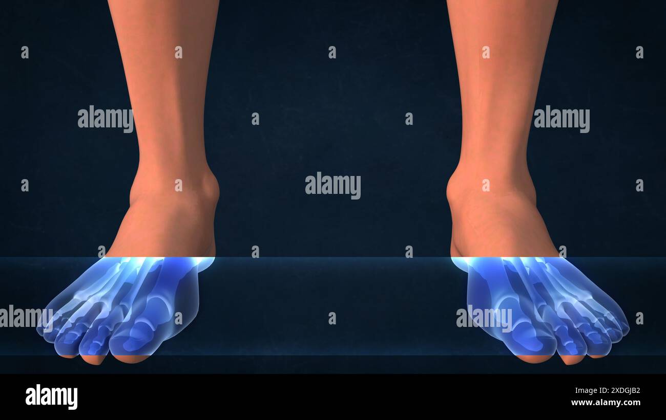 An X-ray of a human feet Stock Photo - Alamy