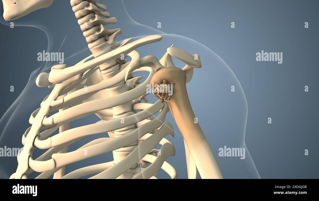 Broken rib mri hi-res stock photography and images - Alamy