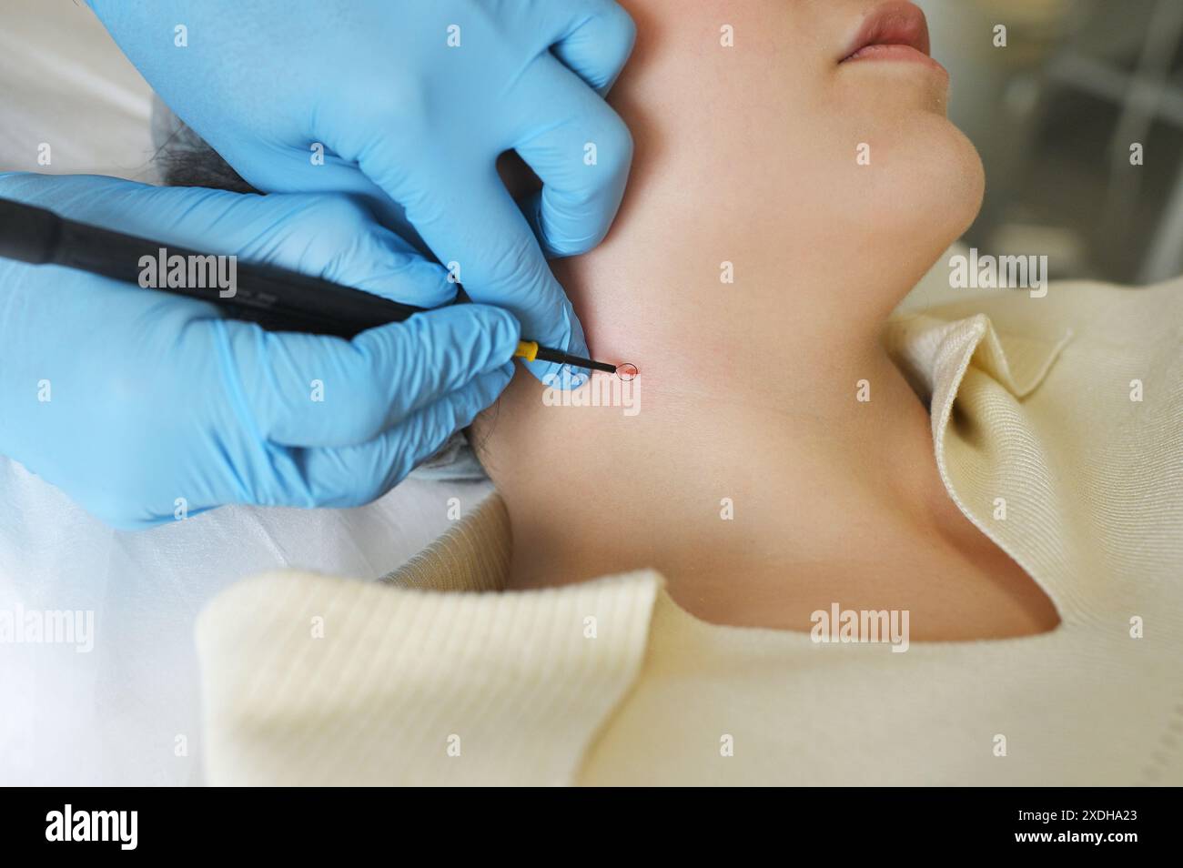 surgeon uses a radio wave knife to remove a neoplasm - a mole or nevus ...