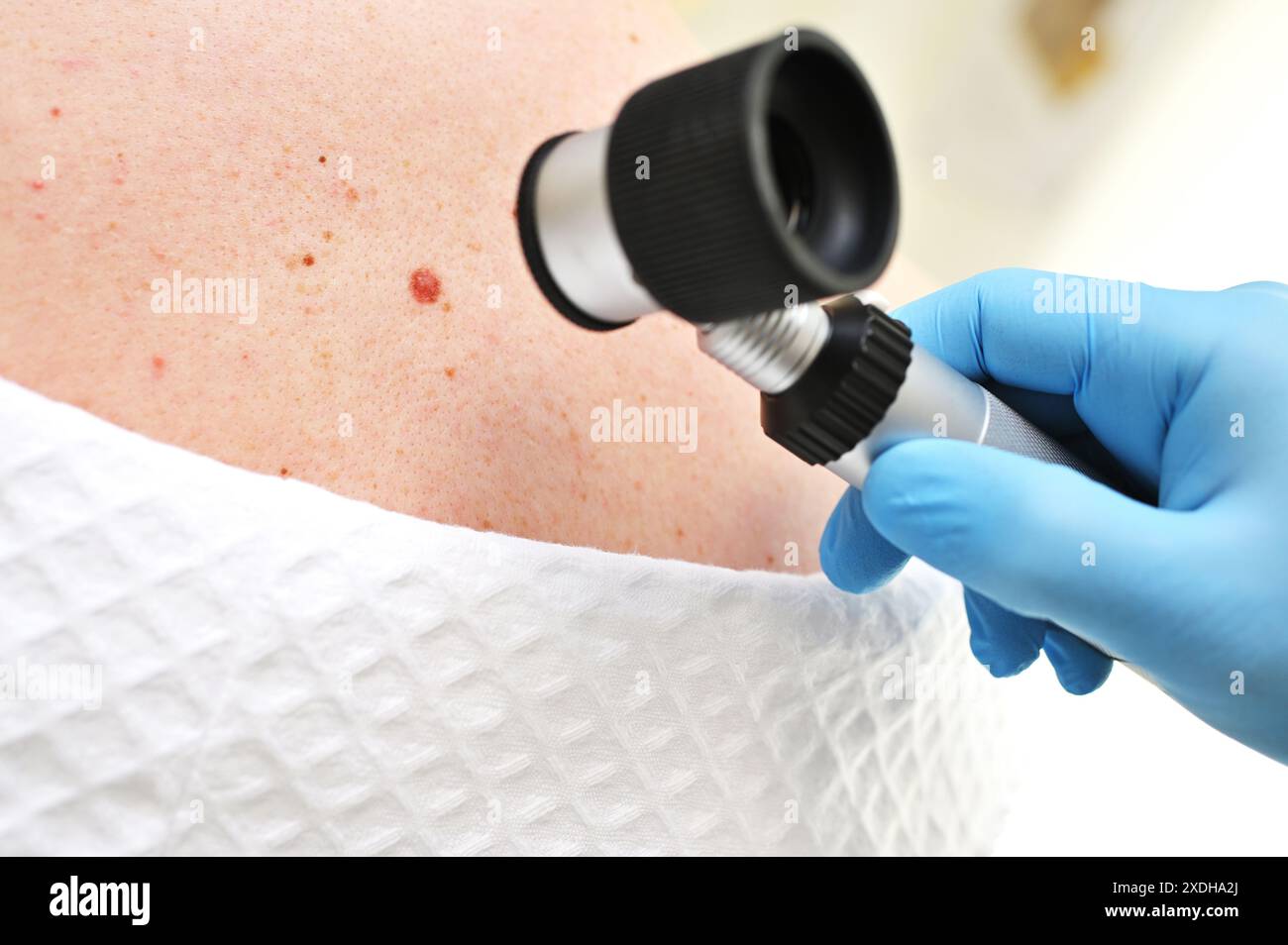 dermatologist oncologist uses a dermatoscope to examine moles and ...