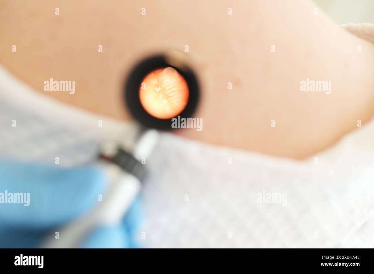 a dermatologist examines moles and skin growths on the patient's body ...