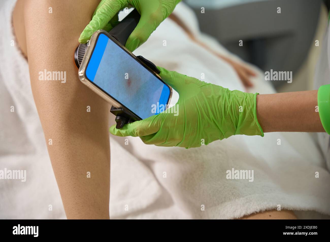 Doctor uses a dermatoscope on the skin of patients leg Stock Photo - Alamy