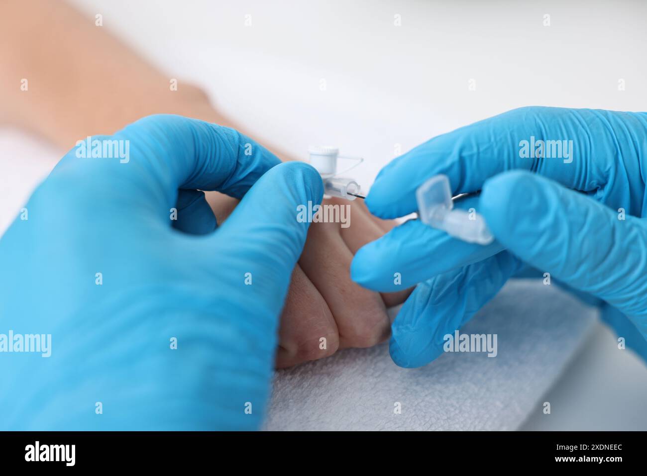 Nurse inputting catheter for IV drip in patient hand, closeup Stock ...