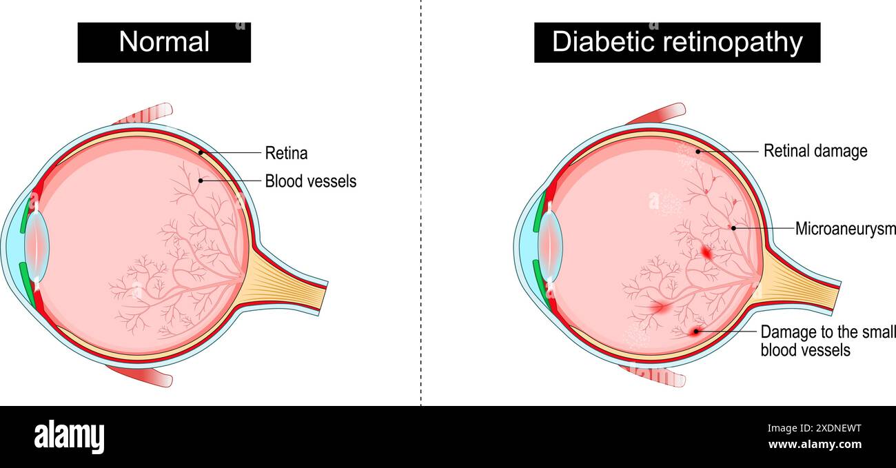 Retinopathy retina eye Stock Vector Images - Alamy