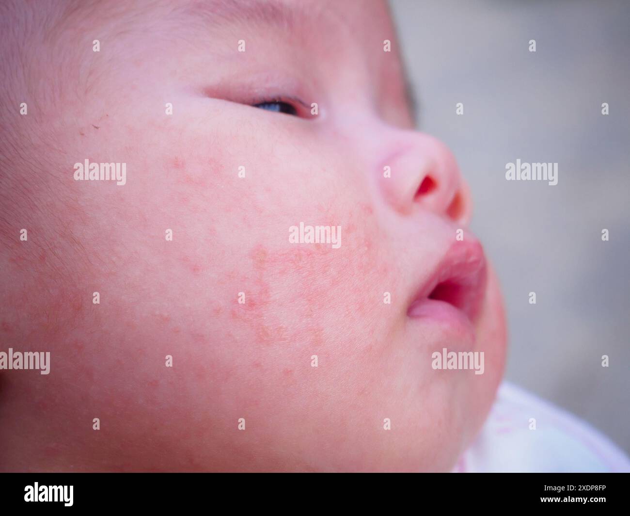 newborn baby with dermatitis allergy on face Stock Photo - Alamy