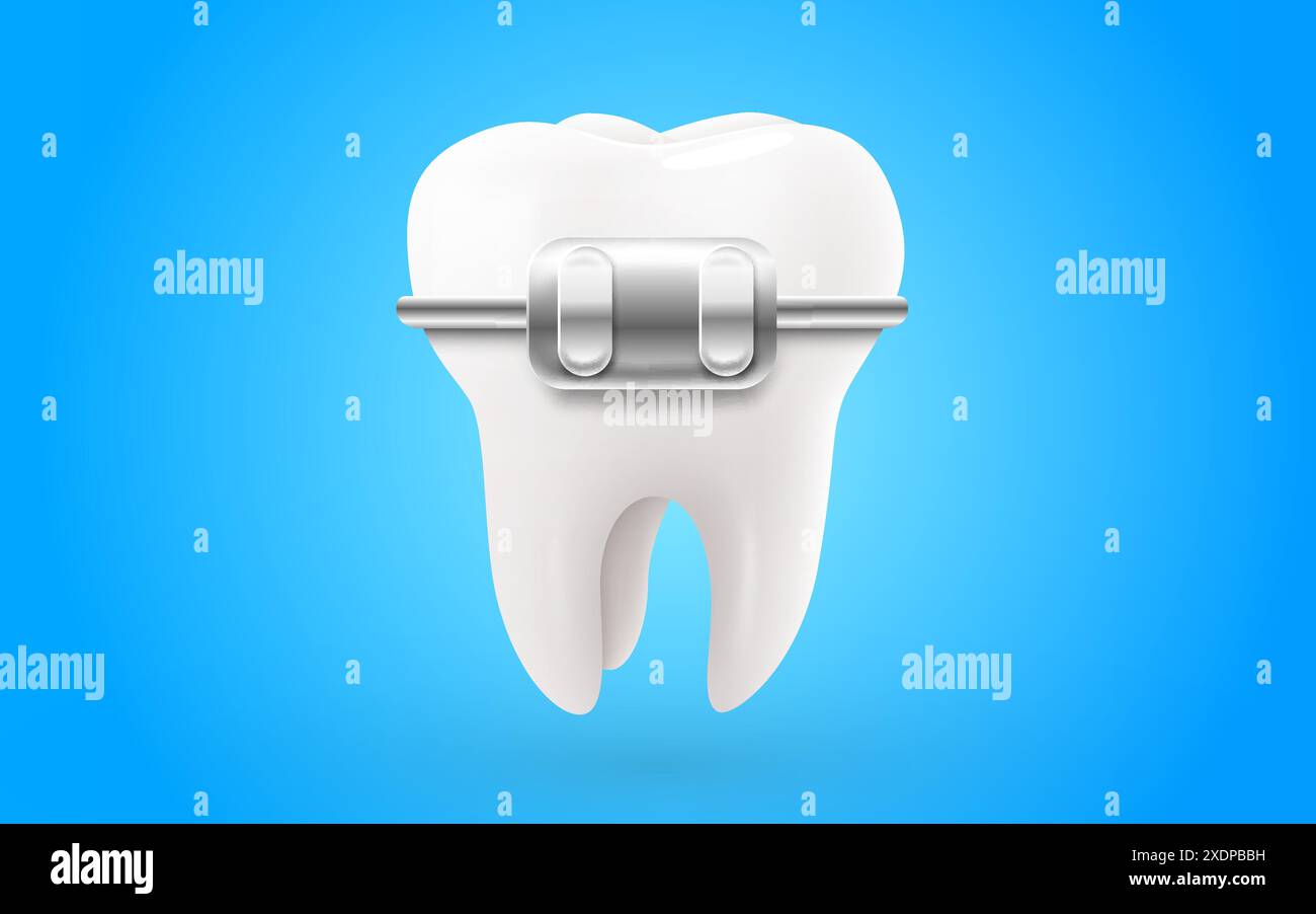 Tooth with braces. 3d vector illustration Stock Vector Image & Art - Alamy