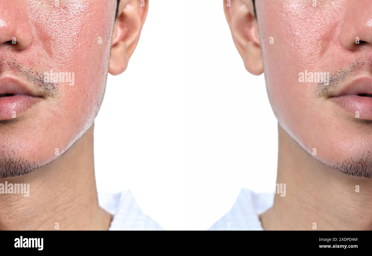 Comparison of skin before and after laser treatment, skin with acne ...