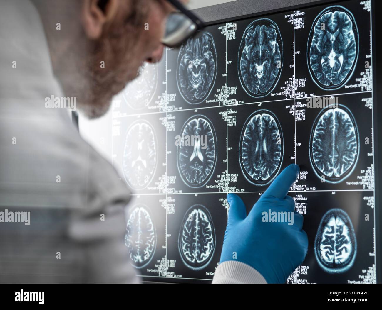 Neurology Research, Doctor viewing a patients MRI brain scan on screen ...