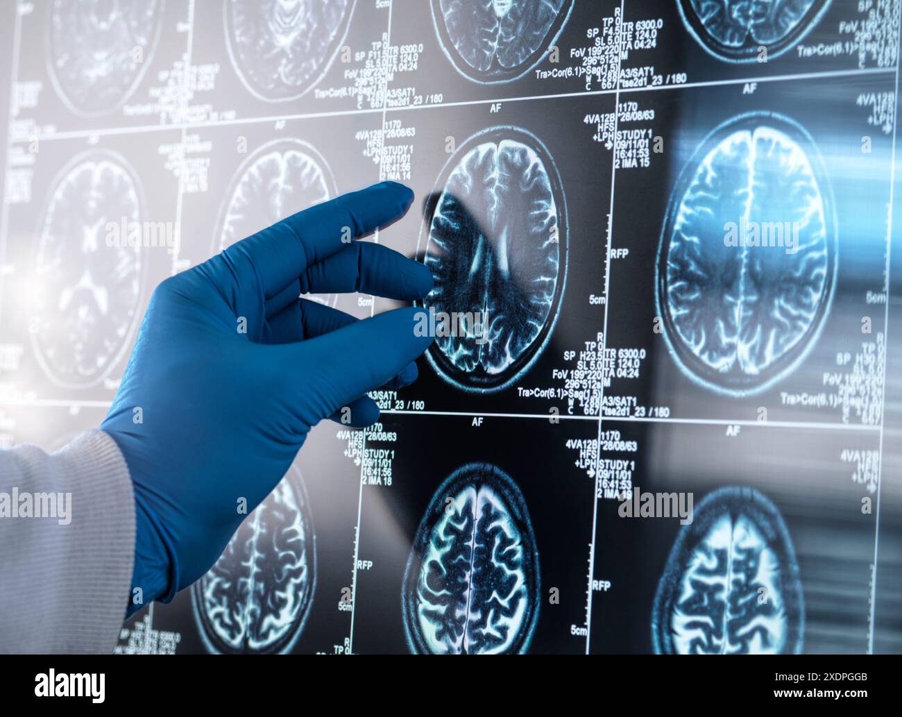 Neurology Research, Doctor viewing a patients MRI Scan for damage Stock ...