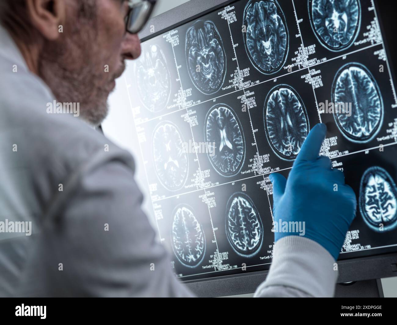 Neurology Research, Doctor viewing a patients MRI brain scan on screen ...