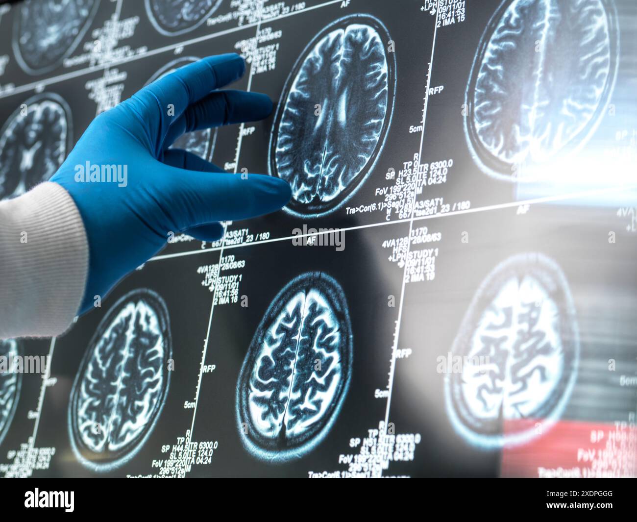 Neurology Research, Doctor viewing a patients MRI Scan for damage Stock ...