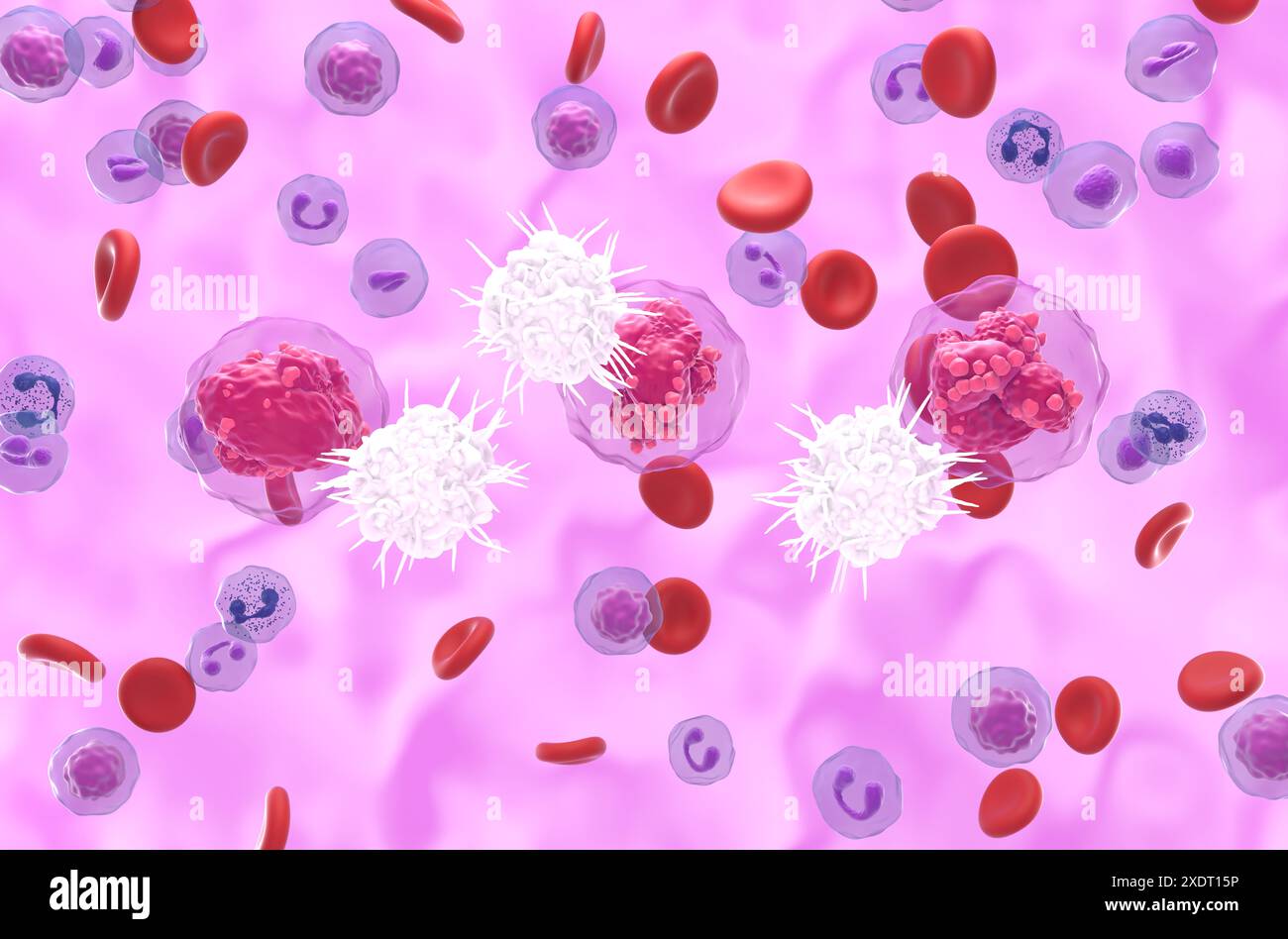 Dendritic cells (DC) recognize Acute Lymphocytic Leukemia (ALL ...