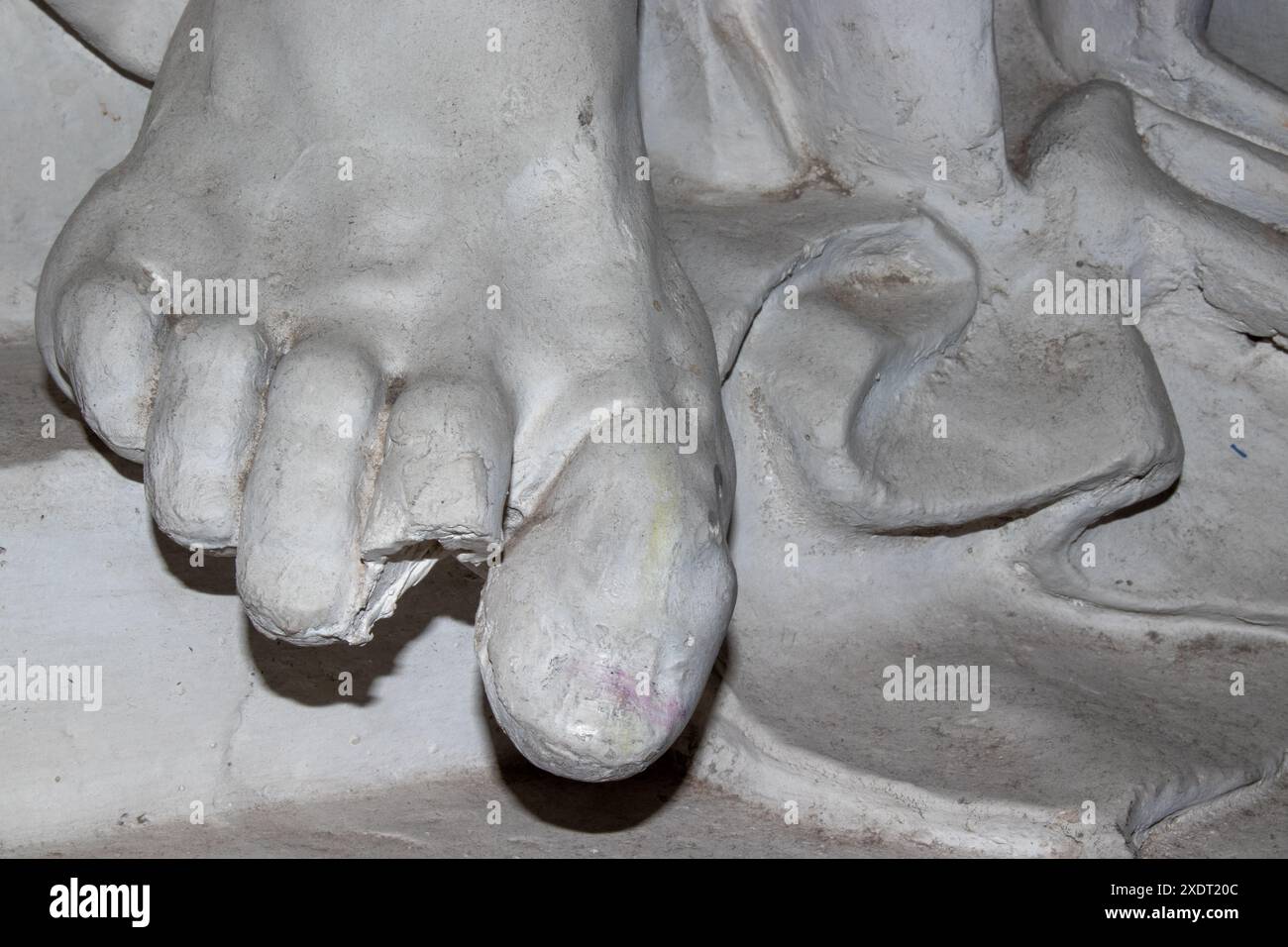 Amputated toe hi-res stock photography and images - Alamy