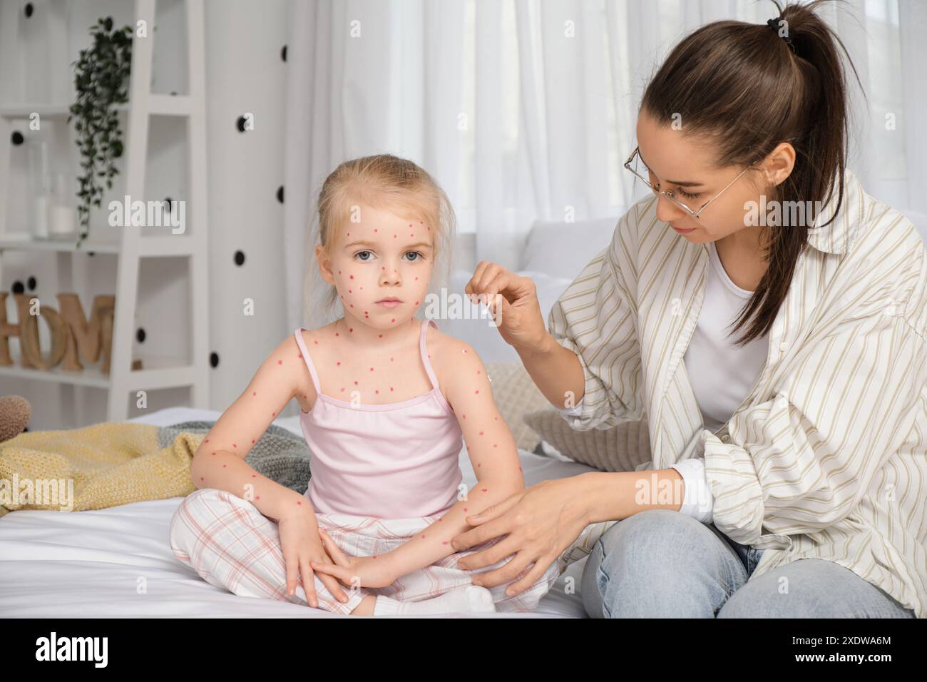 Mother smearing her little daughter ill with chickenpox in bedroom ...