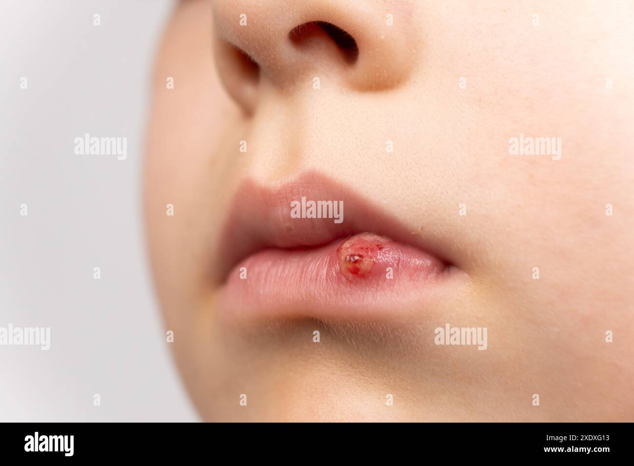 Skin damage, wound, abrasion on the lip of a small child Stock Photo ...