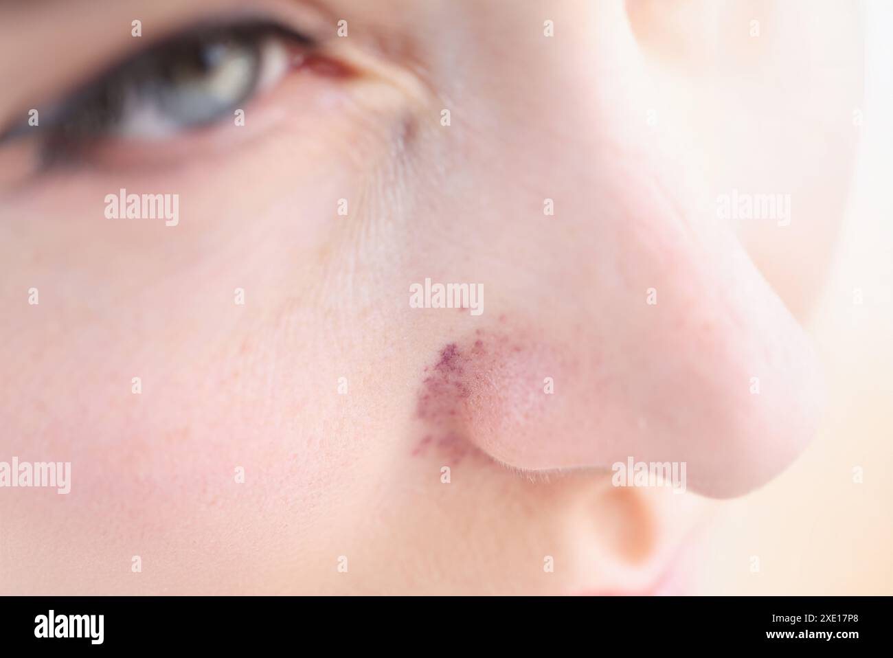 Red cyanotic rash on woman nose closeup Stock Photo - Alamy