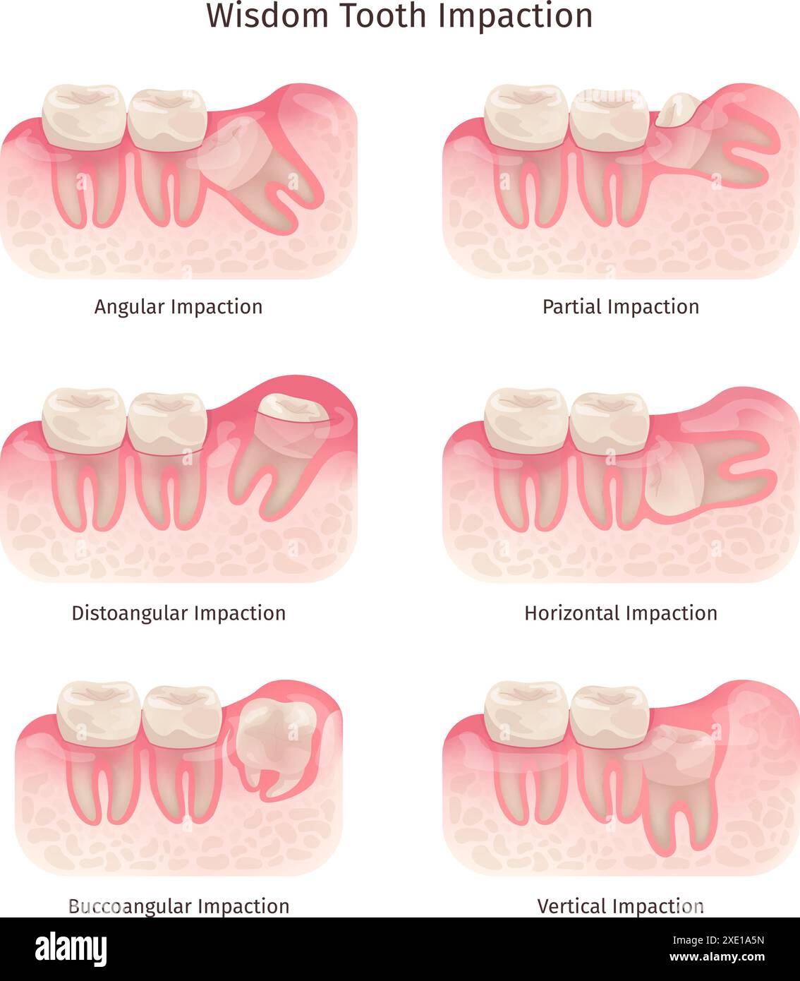 Wisdom tooth. Wisdoms teeth dental problem, molar extraction root canal ...