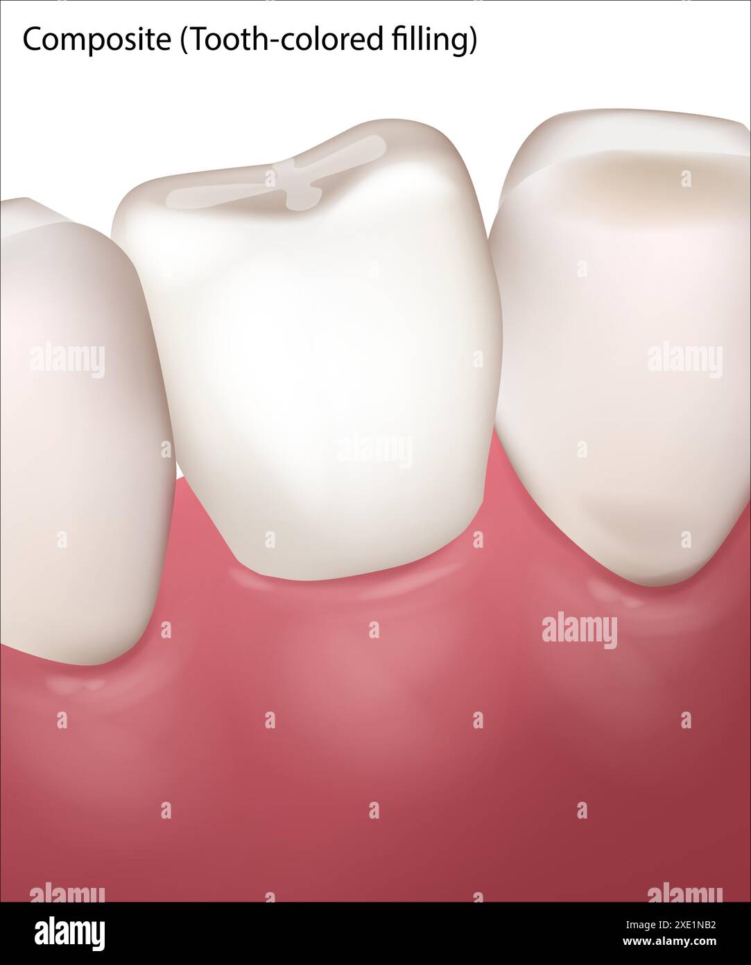 Dental Filling Procedure. Amalgam Silver filling and Composite Tooth ...